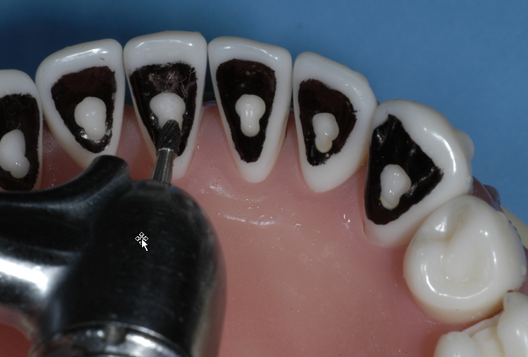 ANTERIOR INLAY-FLANGE BRIDGES - Peter Walford Dentistry