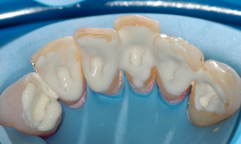 ANTERIOR INLAY-FLANGE BRIDGES - Peter Walford Dentistry