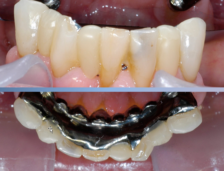 INLAY-FLANGE APPLICATIONS IN REMOVABLE PROSTHETICS - Peter Walford ...
