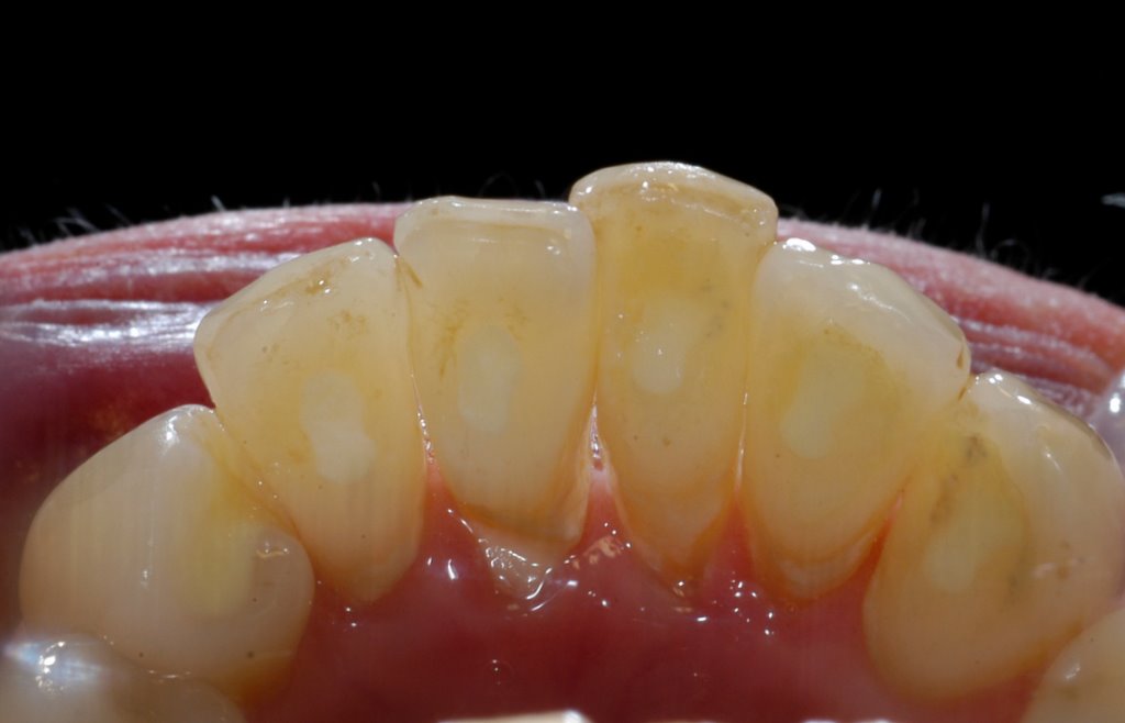 CARIES DETECTOR AS A PLAQUE DISCLOSING AGENT - Peter Walford Dentistry