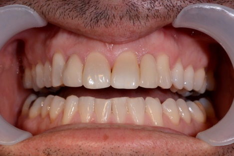 HANDBOOK OF ADHESIVE BRIDGES - Peter Walford Dentistry