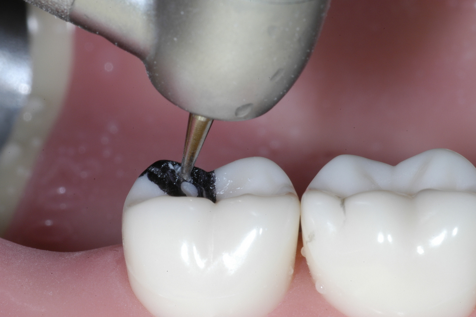 INCLINED-PLANE CUSP REDUCTION METHOD - Peter Walford Dentistry