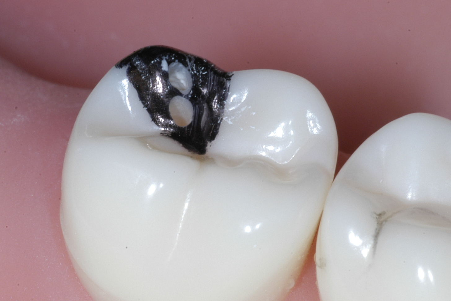 INCLINED-PLANE CUSP REDUCTION METHOD - Peter Walford Dentistry